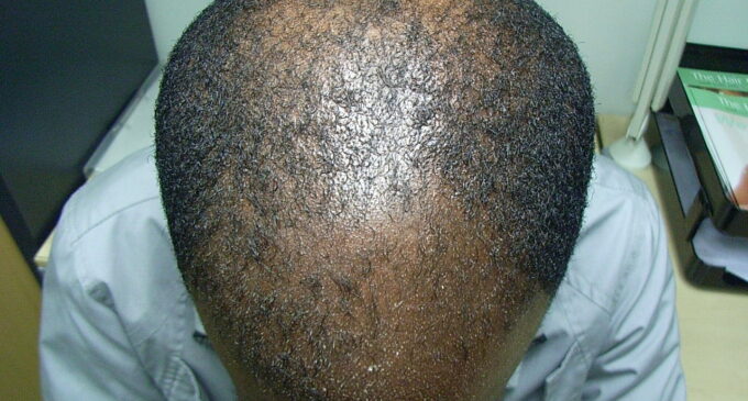 FACT CHECK: Does masturbation cause hair loss in men? | TheCable